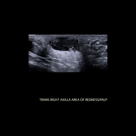 Pediatric Subcutaneous Abscess Pediatric Radiology Reference Article Pediatric Imaging