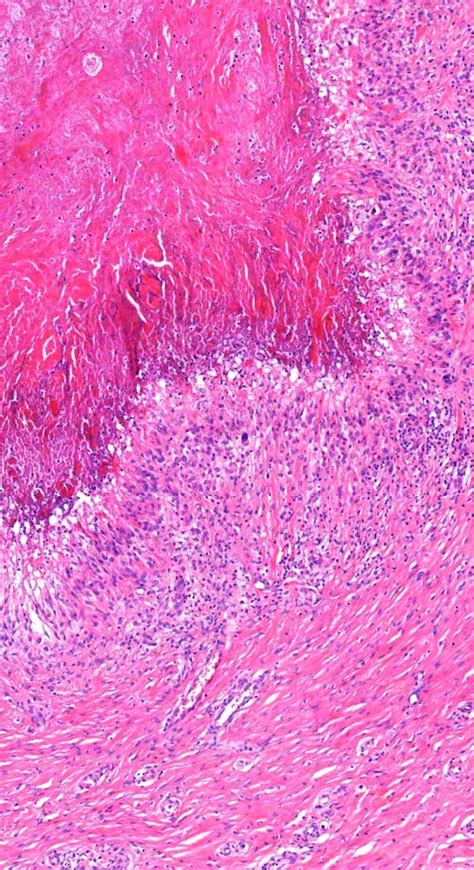 Pathology Of Rheumatoid Nodule Rheumatoid Nodules Subcutaneous Tissue Histology Slides