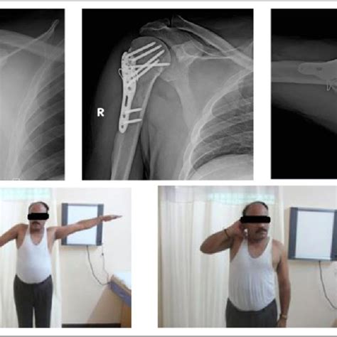 Valgus Impacted Fracture With Anatomical Reconstruction Has Poor