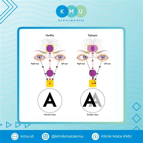 Diplopia Penglihatan Ganda Gejala Penyebab Hingga Pengobatan