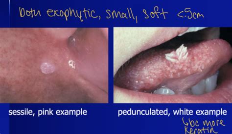 1 Benign Epithelial Neoplasms Flashcards Quizlet