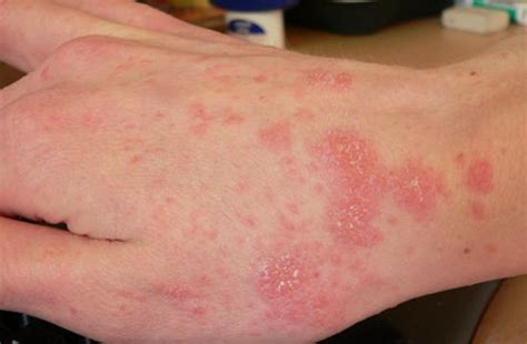 Acropustulosis In Infants Symptoms Causes And Treatment