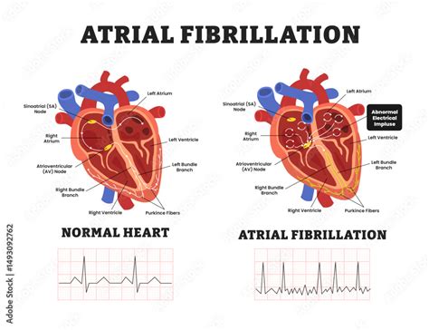 Heart Atrial Fibrillation Vs Normal Heart Educational Medical Poster