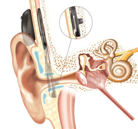 Bone Conduction Implant Vs Cochlear Implant At Sofia Goldman Blog