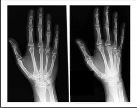 Figure 1 From Giant Cell Tumor Of The Metacarpal Case Report
