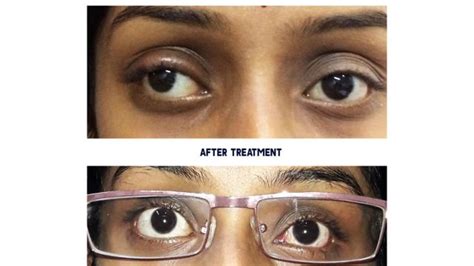 Strabismus Surgery Before And After A Comprehensive Guide To Understanding The Procedure And