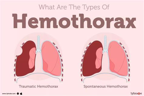 Hemothorax