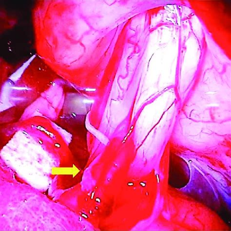 Pdf Vascular Loop Of Anterior Inferior Cerebellar Artery Causing Disabling Tinnitus Vertigo