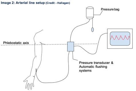 Critical Care Device Series Arterial Lines Part 2 Waveforms And Damping Emra