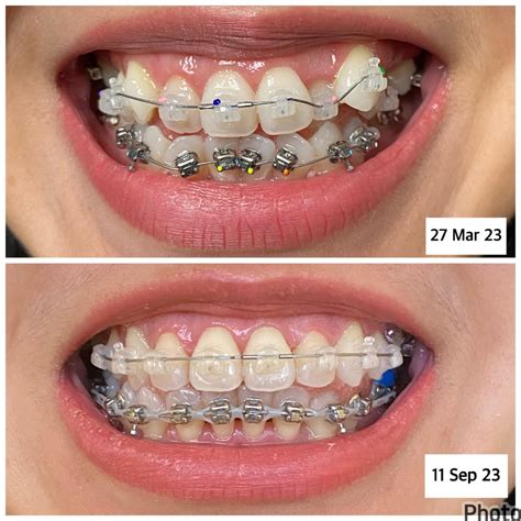Why Do I Have A Lisp After Getting Braces Off Rbraces
