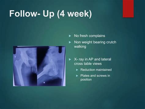 Case Report Acetabular Fracture Goapptx