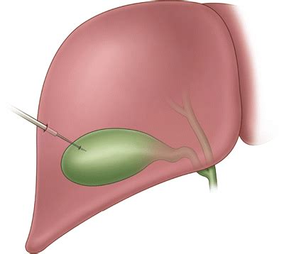 Percutaneous Cholecystostomy Anesthesia Key
