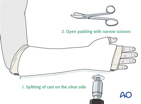 Short Arm Cast