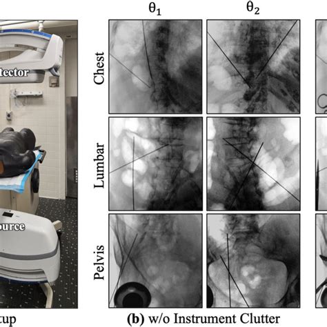 Robustness Of 3d Direction Estimation For Guidewires That Are Nearly