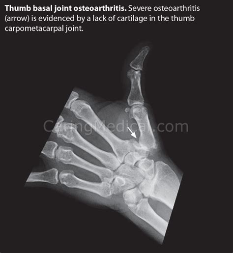 Non Surgical Alternatives For Thumb Osteoarthritis