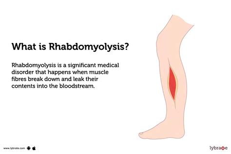 Rhabdomyolysis Causes Symptoms Treatment And Cost