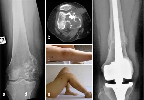 A Patient With Postoperative Recurrence Of Bone Giant Cell Tumor In