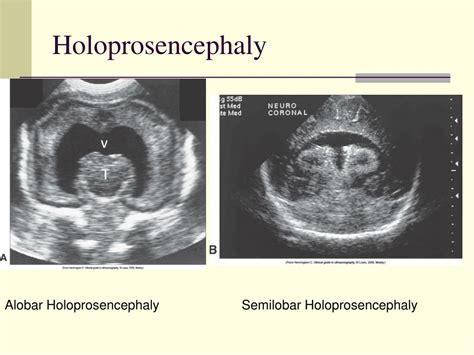 Ppt Neonatal Echoencephalography Powerpoint Presentation Free Download Id 5519290