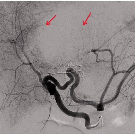 Control Angiography After Embolization Shows Persistent Small