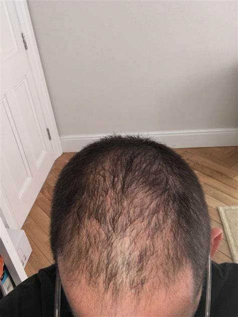 Diffuse Balding This Is After A Buzz 3 On Top And 1 Onsides I