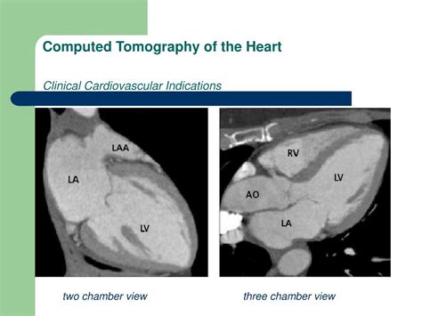 Ppt Cardiovascular Imaging With Computed Tomographyct Powerpoint
