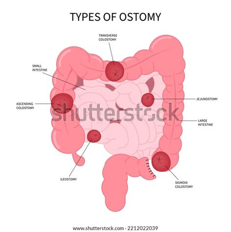 Loop Ileostomy Diagram