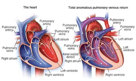 Total Anomalous Pulmonary Venous Return Tapvr The Heart Clinic