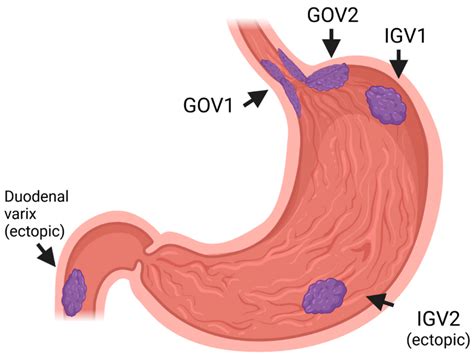 Endoscopic Classification Of Gastric Varices According To Sarin Download Scientific Diagram Endoscopic Classification Of Gastric Varices According To Sarin Download Scientific Diagram