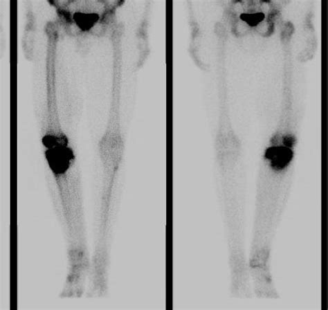 Osteosarcoma The Bone School