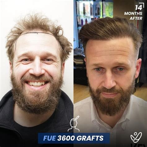 Dht And Hair Loss Causes Treatments And Solutions Estenove