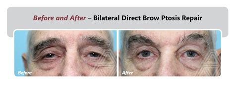 Brow Ptosis Triad Eye Institute