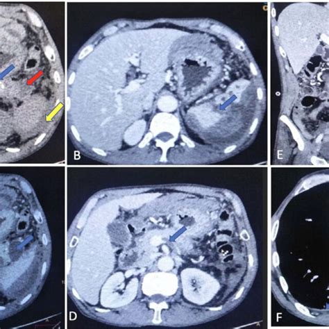 Modified Ct Severity Index Ctsi Download Scientific Diagram