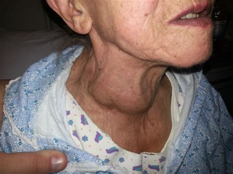 Neglected Nontoxic Multinodular Goiter Presented As A Large Neck Mass Pmc
