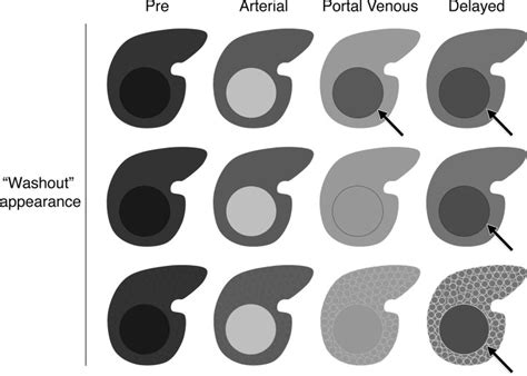 Evidence Supporting Li Rads Major Features For Ct And Mr Imaging Based Diagnosis Of