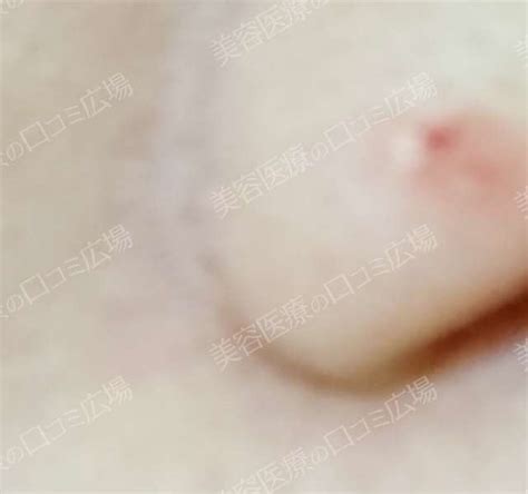 ホクロ除去 アブレーション ほくろ除去あざ治療イボ治療の症例 東京美容外科 CS72783 美容医療の口コミ広場