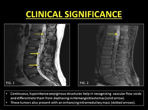 Figure 1 From CSF Flow Artifacts In The Spine A Boon Or A Bane Semantic Scholar