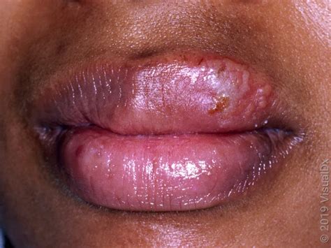 What Does A Cold Sore Look Like Heres How To Diagnose One Goodrx