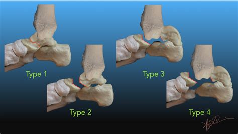 Talus Fracture X Ray View At Luca Glossop Blog