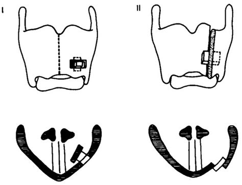 Thyroplasty Surgery Types Indications Complications And Recovery