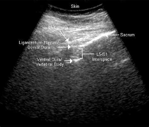 Ultrasound Image In The Longitudinal Plane Showing The Sacrum And The