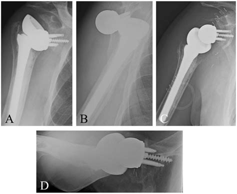 A 80 Year Old Man S P Rtsa For Rotator Cuff Arthropathy Two Week Download Scientific Diagram