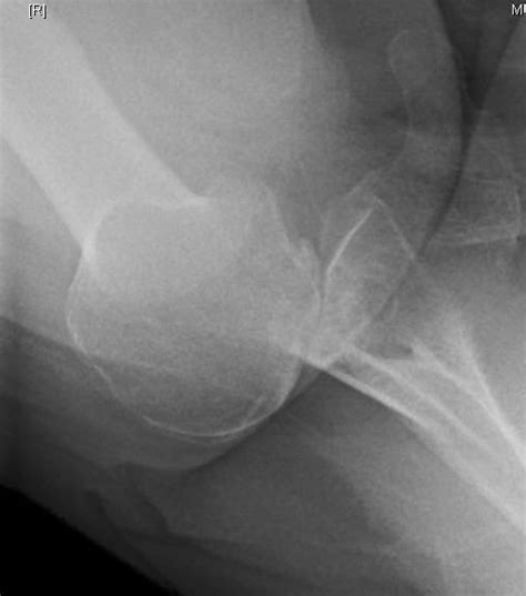 Uw Shoulder And Elbow Academy Managing Glenoid Retroversion In 2018