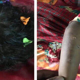 Multiple Lesions Of Different Sizes Present On The Skin Of The Whole Download Scientific