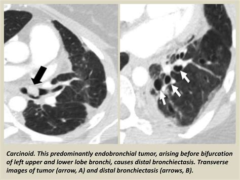 Presentation1 Pptx Radiological Imaging Of Bronchiectasis Pptx