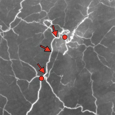 Five Different Delayed Thoraco Groin Flaps At Different Times Based On