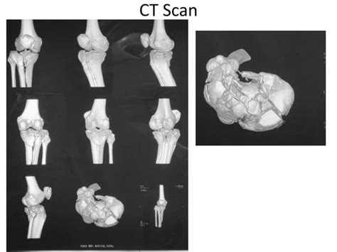 Proximal Tibia Fracture Ppt