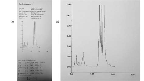 Hplc Graph Shows No Peak And No Result In Hba1c With A Full Image And Download Scientific