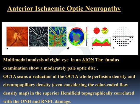Prognostic Value Of Multiple Differential Diagnosis Of Onh By Oct Angio Pptx