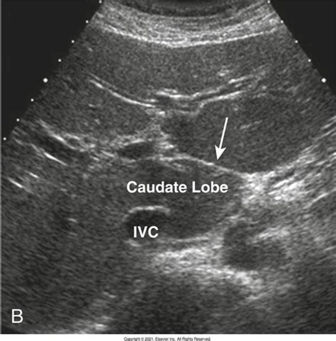 Sonography Scanning Chapter 6 Flashcards Quizlet