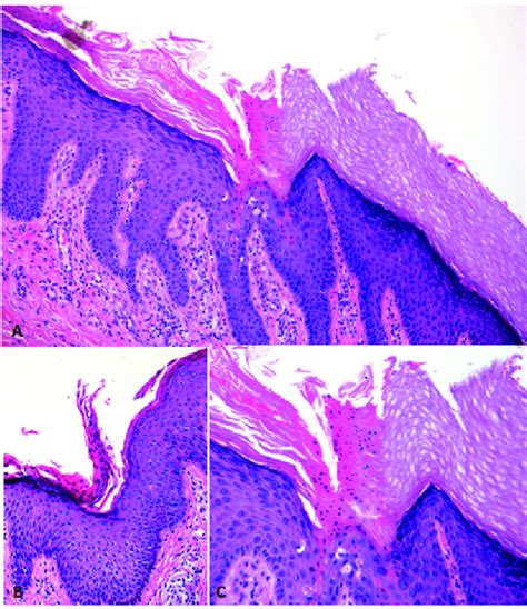 Histopathological Examination A The Obliquely Oriented Cornoid
